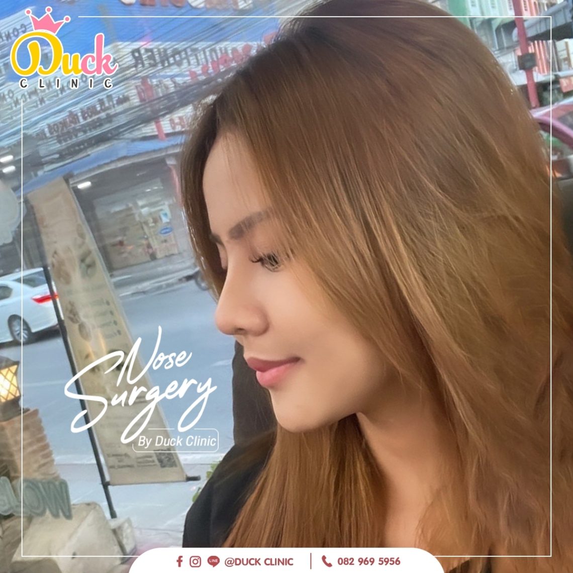 รวม 10 คลินิกเสริมจมูก ราคาไม่แพง ฝีมือดี จ่ายแค่หลักพัน - ออนฟอน | Onfond